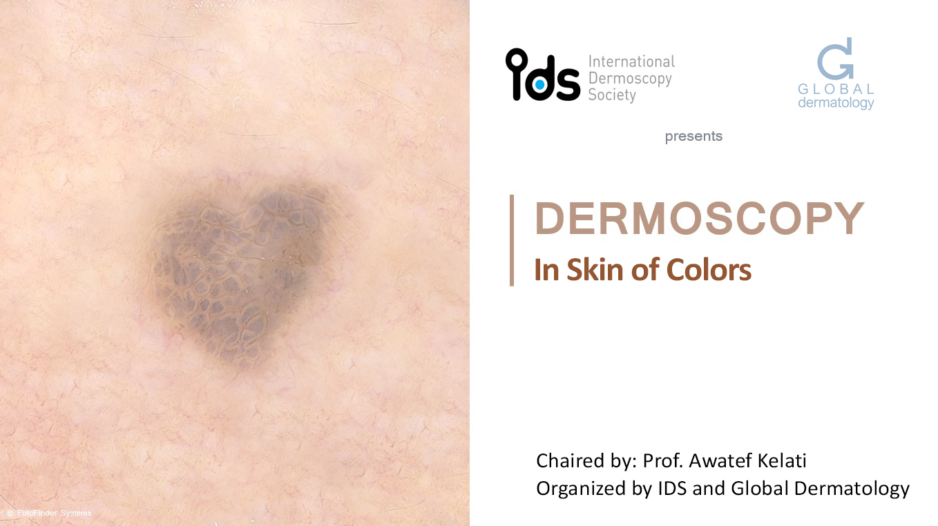 Dermoscopy Skin of Color - Course - Global Dermatology